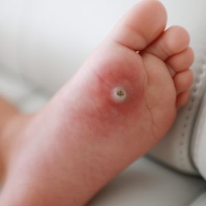 Understanding Warts in Children – Causes, Types, and Effective ...